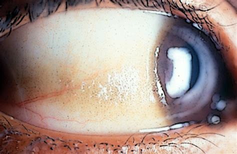 Bitot Spots Causes Symptoms And Treatment