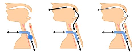 Tracheostomy Emergencies In Adults Rcemlearning