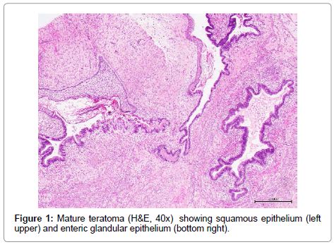 Teratoma Histology