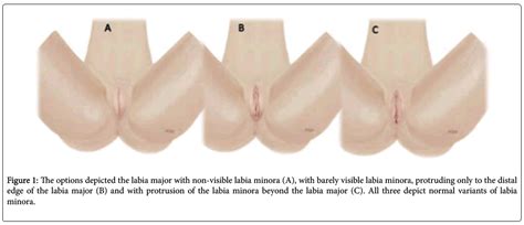 Preferences In The Aesthetic Appearance Of The Female External Genitalia