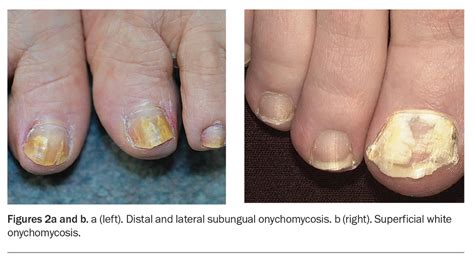 Fingernail Diseases