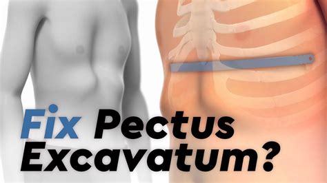 Pectus Excavatum Causes Figure 2 From Pectus Excavatum From A