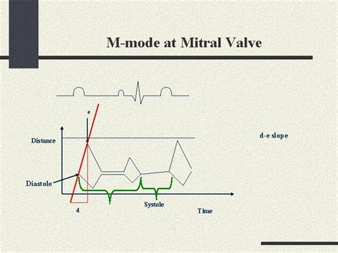 Mmode Echocardiogrphy The Lost Art Mmode Physics B