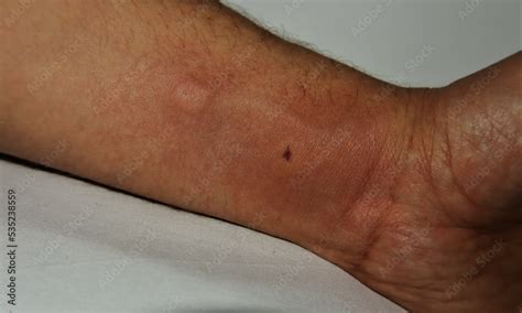 Two Bee Stings On The Arm Of A Man Stung By Worker Bees Skin Allergy