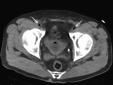 Symmetrical Femoral Vein Bubble Caused By Decompression Illness