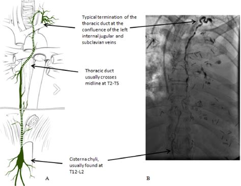 Figure 1 From Imaging And Embolization Illustration Of Variable Thoracic Duct Anatomy For