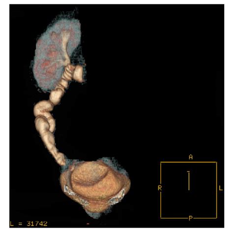 Three Dimensional Reconstructed Ct Scan Performed After Surgery Download Scientific Diagram