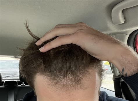 Promising Progress After Just Starting Finmin 24 Yo Male Rtressless