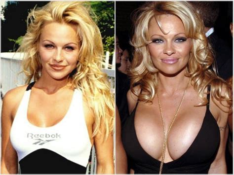 Pamela Anderson Boob Job