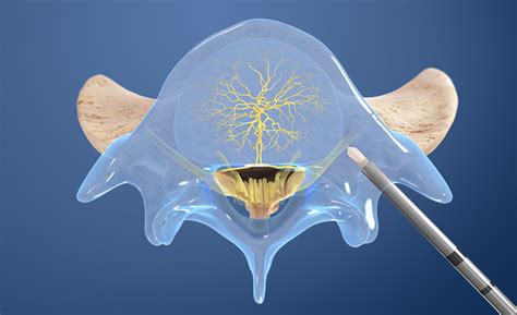 Nerve Root Ablation