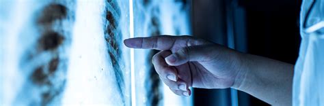 Lung Opacity All About Cloudy Lungs Happiest Health