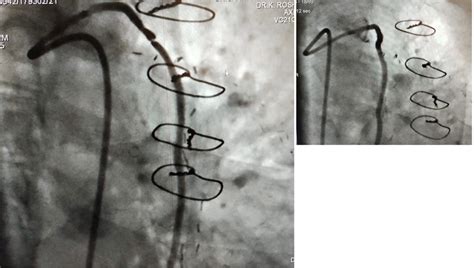 Saphenous Vein Graft Disease Interventions Indian Journal Of