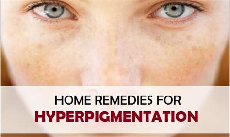 7 Best Home Remedies For Hyperpigmentation Cure