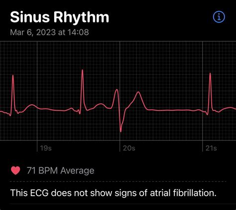 Premature Ventricular Contractions Ecg Fragmentation Of Ventricular