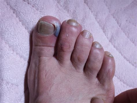 발톱옆 멍물집 지식in