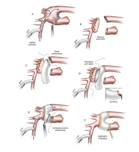 Juan Olivello Juan Md On Linkedin Aortic Arch Replacement Arch Vessel