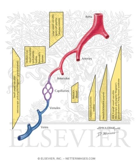 Distribution Of Specific Vasculitis Syndromes