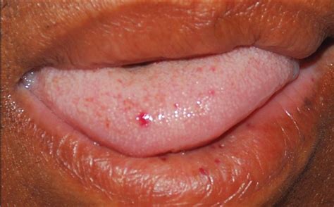 Hereditary Hemorrhagic Telangiectasia Fatigue And Dyspnea Cmaj