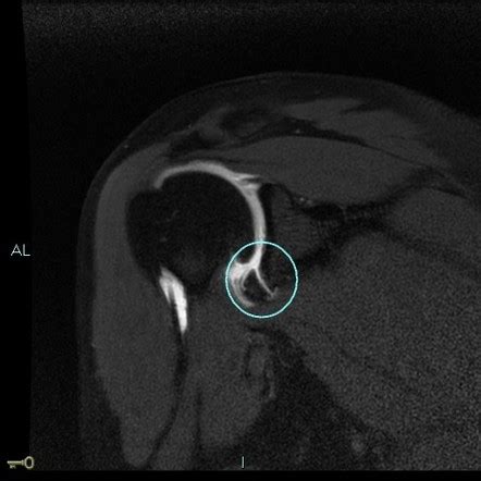 Bankart Lesions Sports Med Review