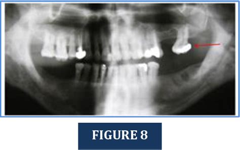 Figure 1 From Validity Of Crown To Root Ratio As A Prognostic Tool In Clinical Practice
