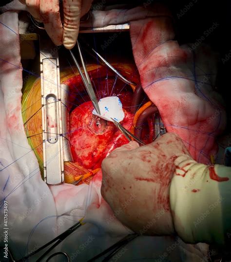 Surgeon Used Dacron Patch For Closure Of Ventricular Septal Rupture