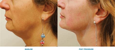 Hifu Before And After Photos London Premier Laser And Skin Clinic