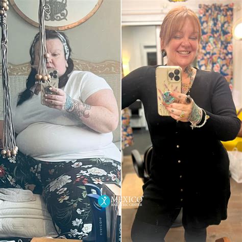 Mini Gastric Bypass Before And After Mini Bypass Package In Cancun