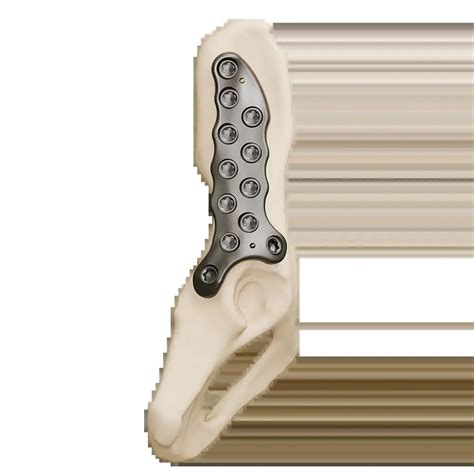 Flip Fusion Implants