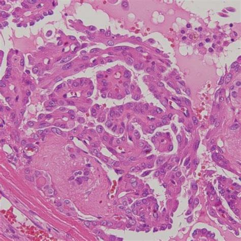 Insular Type Growth Pattern Pdc In Who Definition And Turin Download