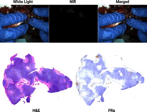 Squamous Cell Cancer Lesion With Negative Frα Staining And Lack Of