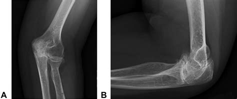 Elbow Arthritis Journal Of Hand Surgery