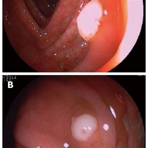 Colonoscopy Images Showing Two Polyps 4 And 6 Mm In Size In The Right
