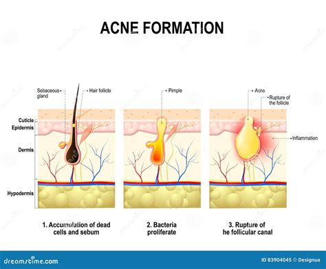 Formation Of Acne Vector Illustration 65571568