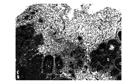 Xenium Breast Cancer Dataset • Voyager