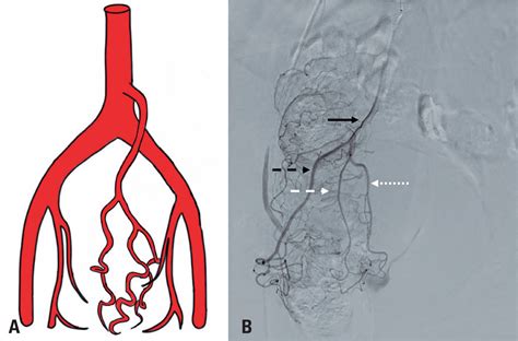 Scielo Brasil Angiographic Description Of The Superior Rectal Artery