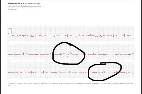 Different Types Of Pvcs On An Ecg Rpvcs