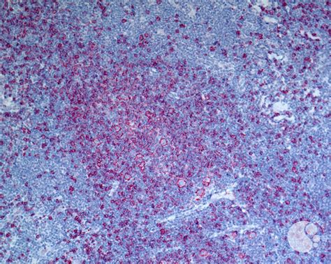 Nlphl With Progression