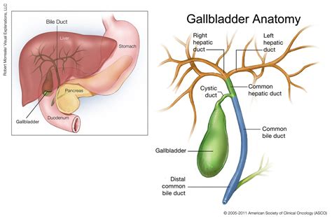 Gallbladder Gallstones