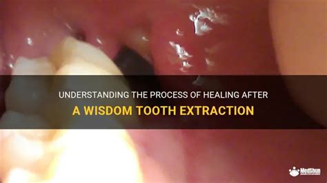 Understanding The Process Of Healing After A Wisdom Tooth Extraction