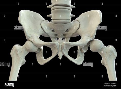 Illustration Of Hip Dysplasia Dislocation Type Showing Misalignment