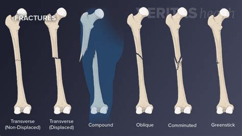 Bone Break Vs Fracture