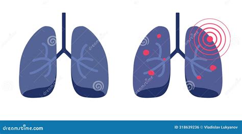 Lungs Healthy And Sick Icon Vector Graphic Illustration Set Human