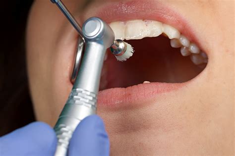 Las Profilaxis Dentales ¿cuándo Es Necesaria Vitis