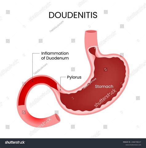 Duodenitis Síntoma Inflamación Del Duodeno Vector De Stock Libre De
