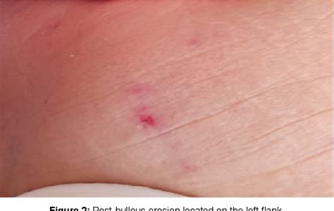 Figure 1 From Endocrinology Clinical Research A Rare Case Of Bullosis