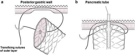 Pancreaticogastrostomy: a pancreas-transfixing method with duct-to-mucosa anastomosis (with ...