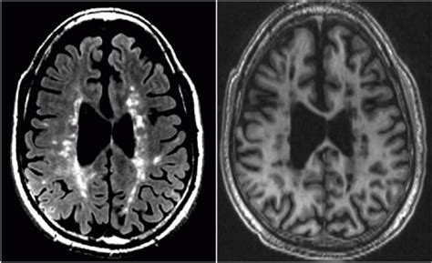 Multiple Sclerosis And Other Demyelinating Diseases Neupsy Key