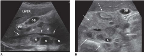 Retroperitoneal Pathology Flashcards Quizlet