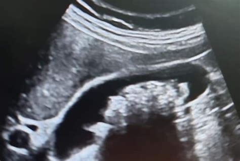 Radiology Pages Multiple Gall Bladder Calculi