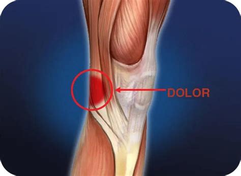 Dolor Detrás De La Rodilla Causas Síntomas Y Tratamiento Doctor Online